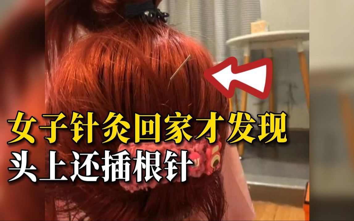 女子针灸回家才发现头上还有根针忘拔了,针都歪了
