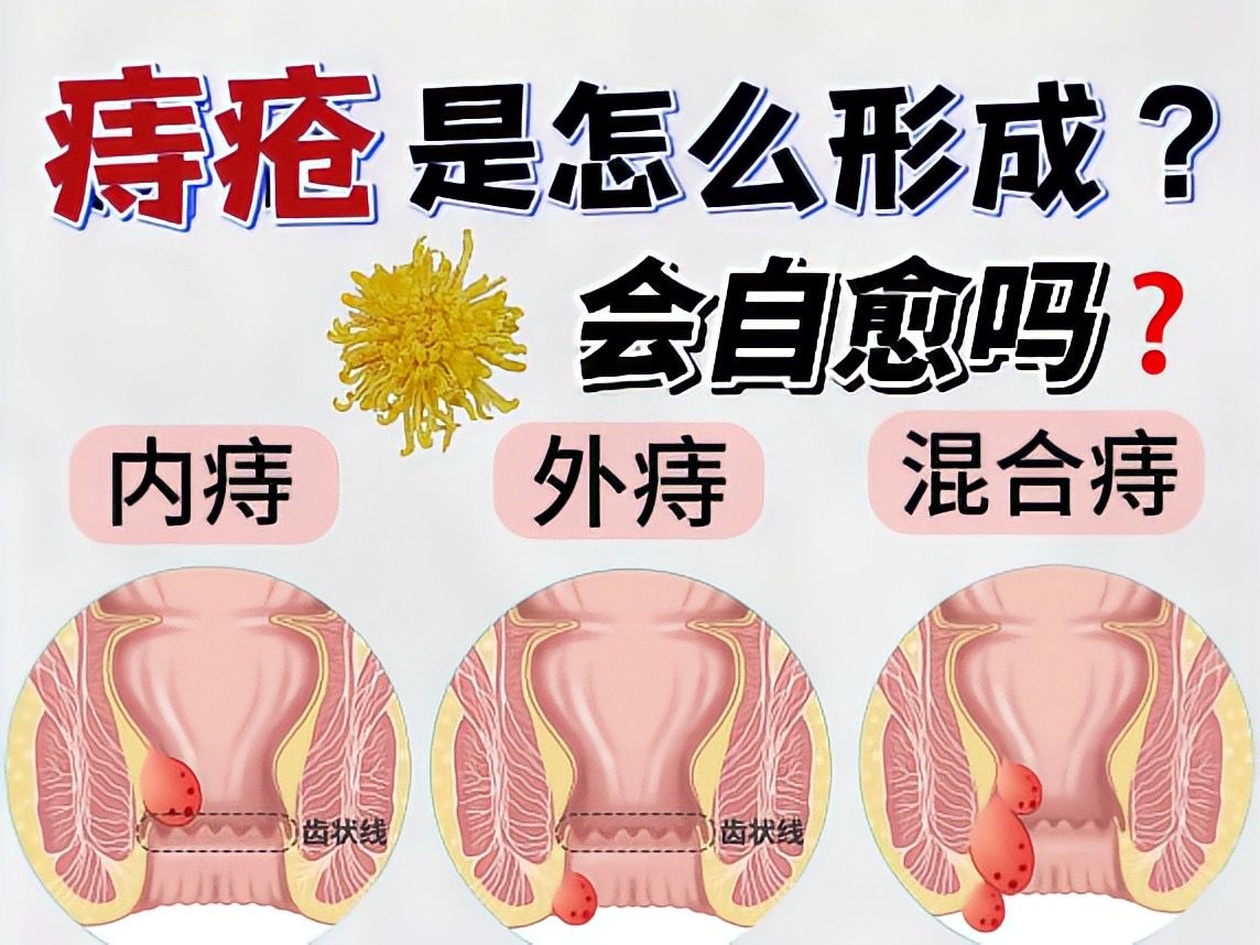 痔疮科普I你的痔疮是怎么形成的?会自愈吗?