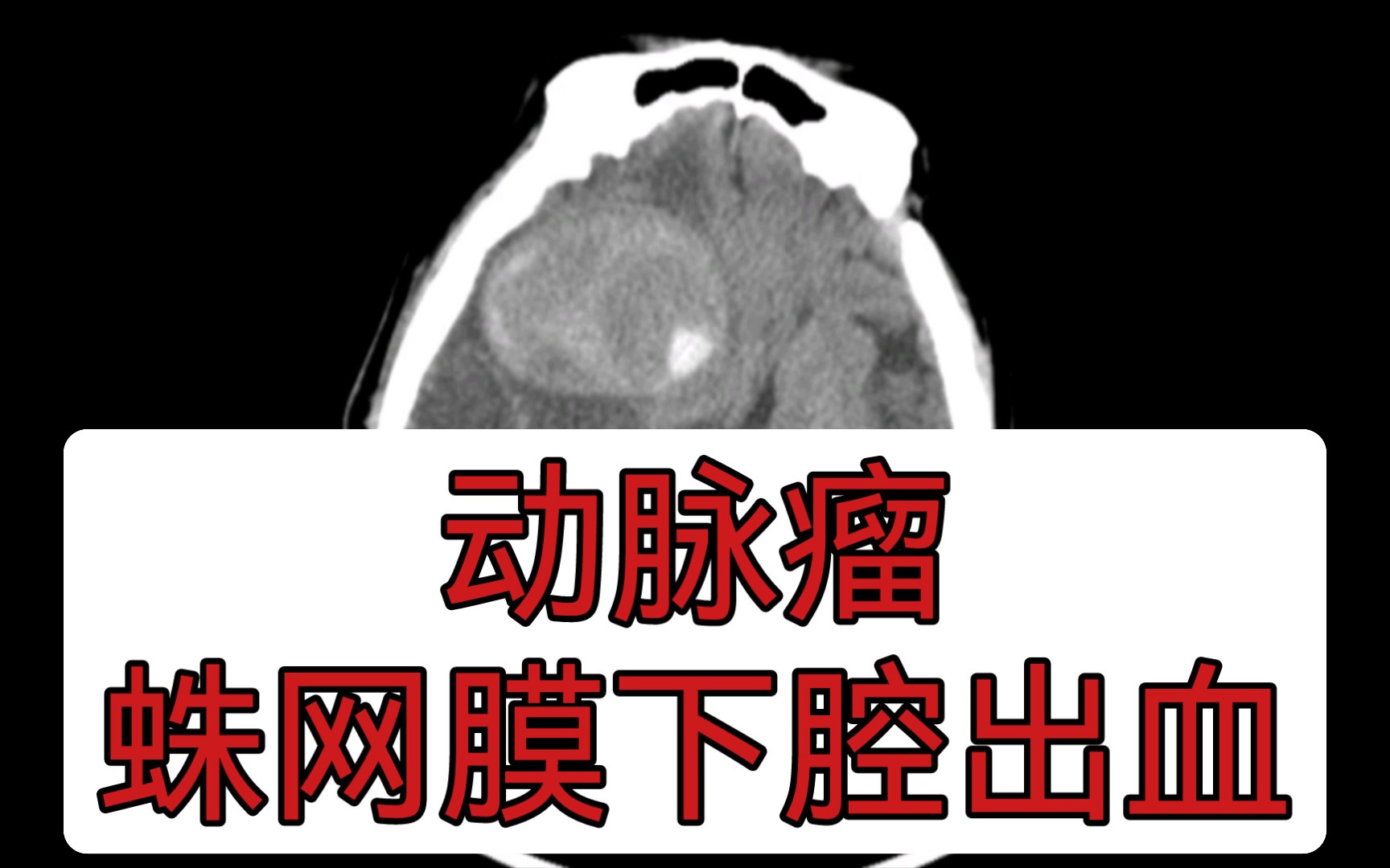 【影像读片】蛛网膜下腔出血 | 动脉瘤 | CT报告书写