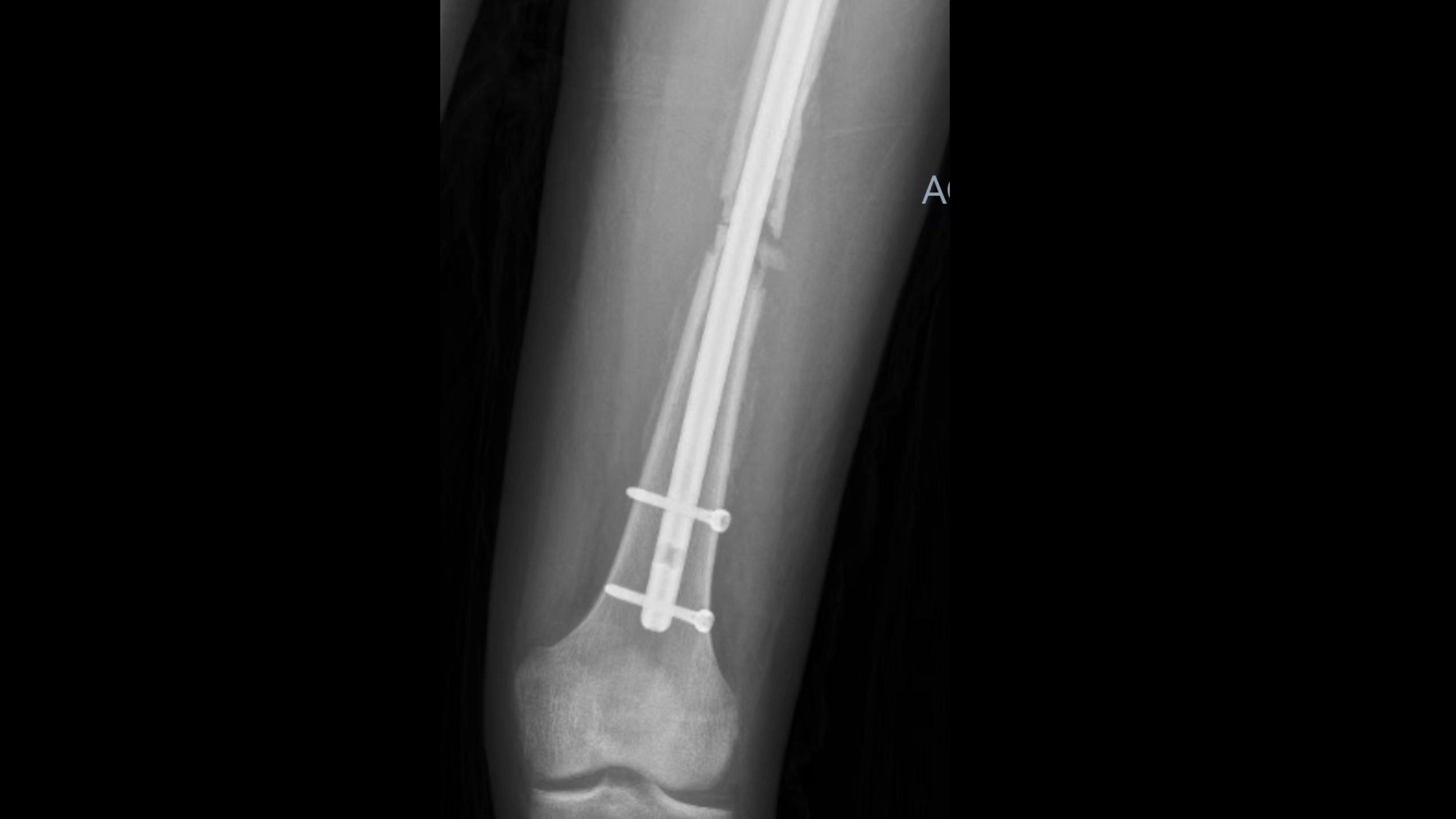 手术教学视频:左股骨干骨折髓针术后FRI内固定物取出、扩创、抗生素...