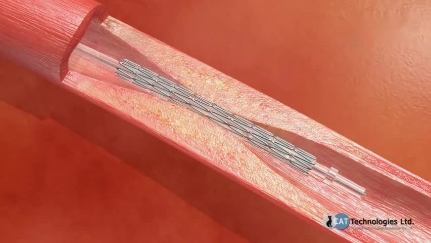 医学3D动画演示:冠状动脉支架植入术全过程