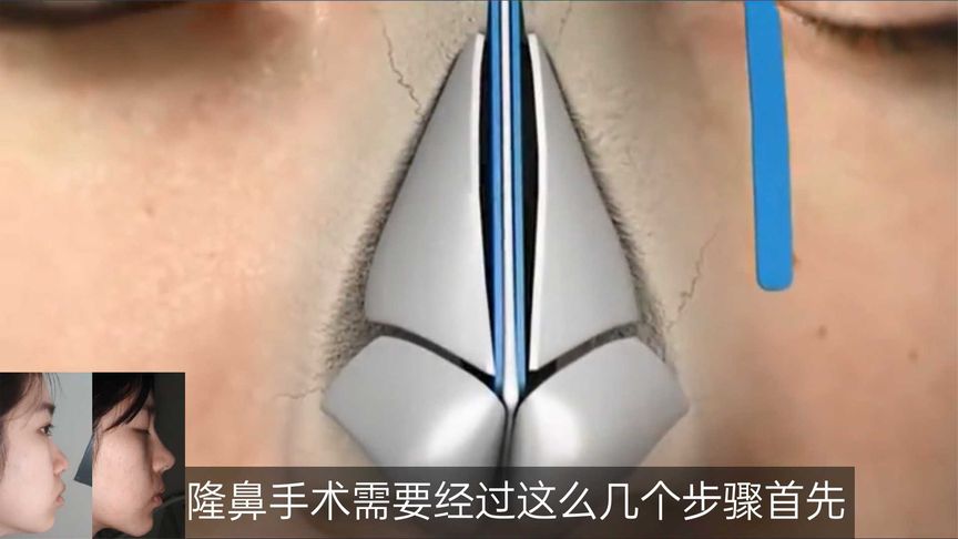 隆鼻手术到底有多神奇?3D动画模拟手术过程,让你眼见为实!