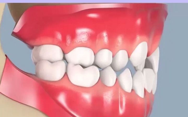 牙间隙的问题也要重视起来