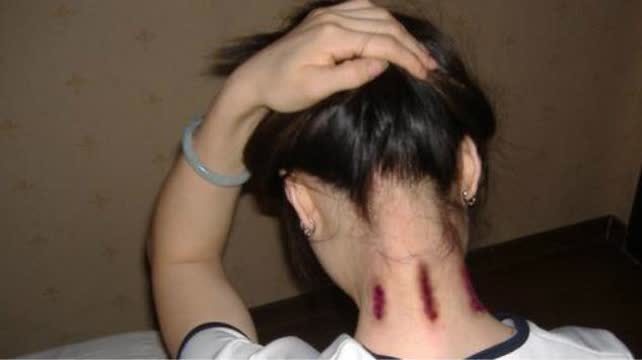 揪揪痧揪脖子痧