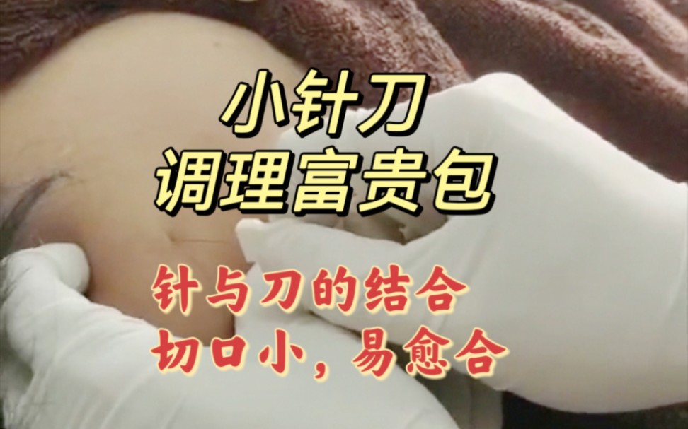小针刀调理富贵包(针与刀的结合,接口小,易愈合)-姚老师