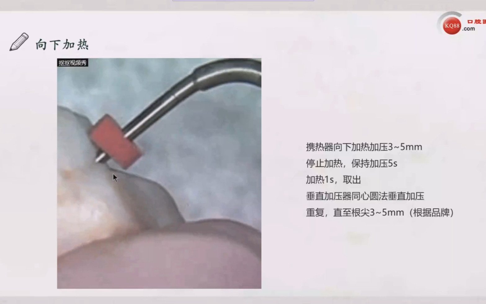 孙宇 KQ88卓越根管——根管充填之热牙胶充填法