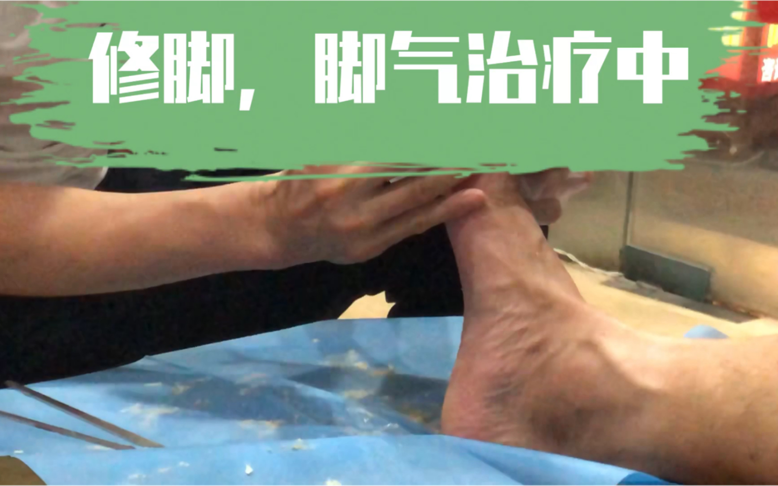 修脚,脚气治疗中,脚气的症状分三类:水泡型脚气、角化型脚气、糜烂性...
