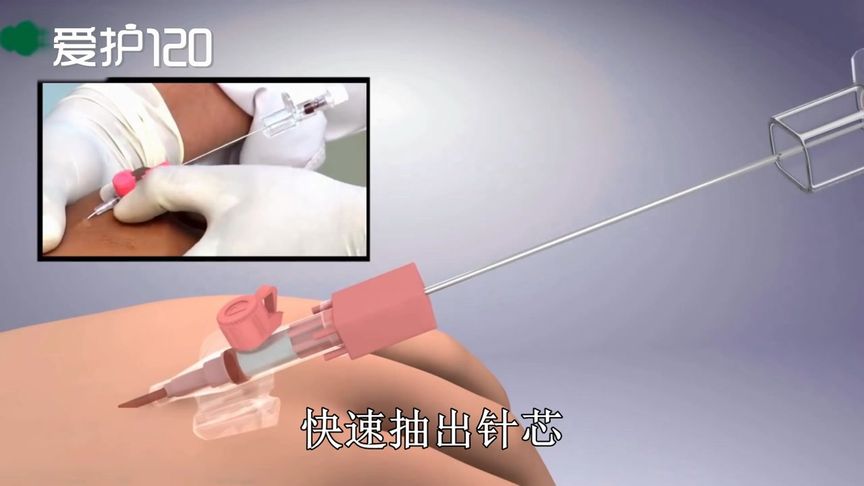 静脉插管操作安全事项,临床护理请收藏!