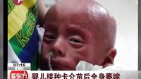婴儿接种卡介苗后全身萎缩医治无望