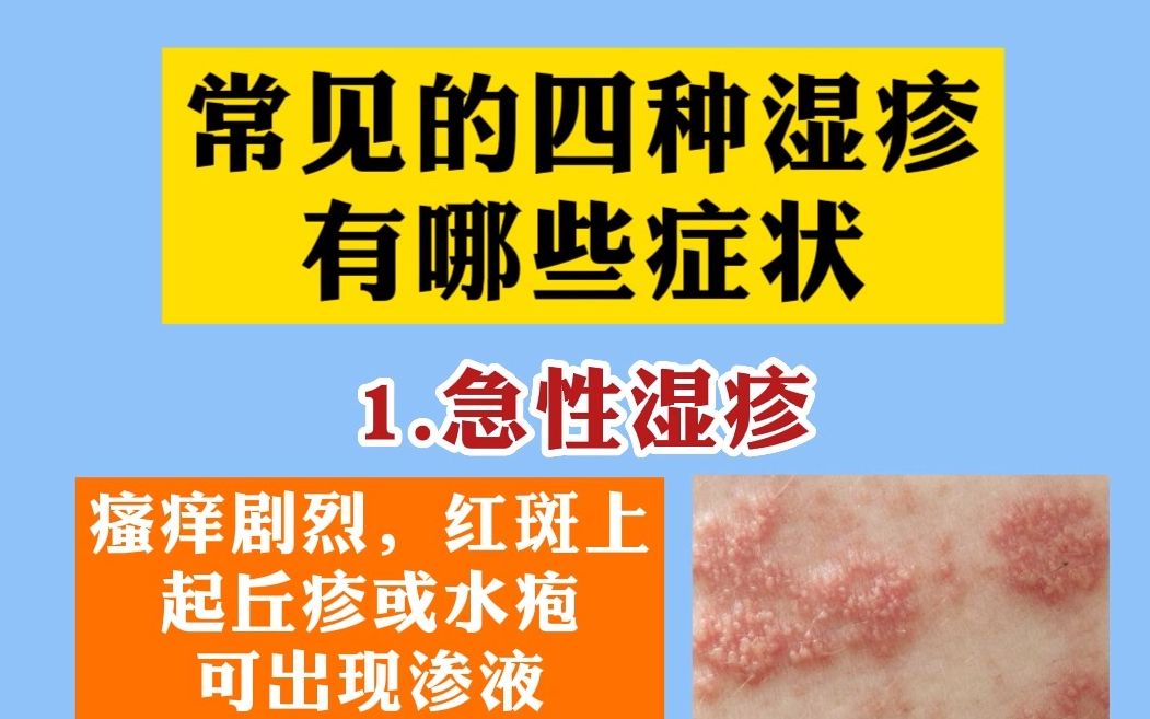 常见的四种湿疹有哪些症状?