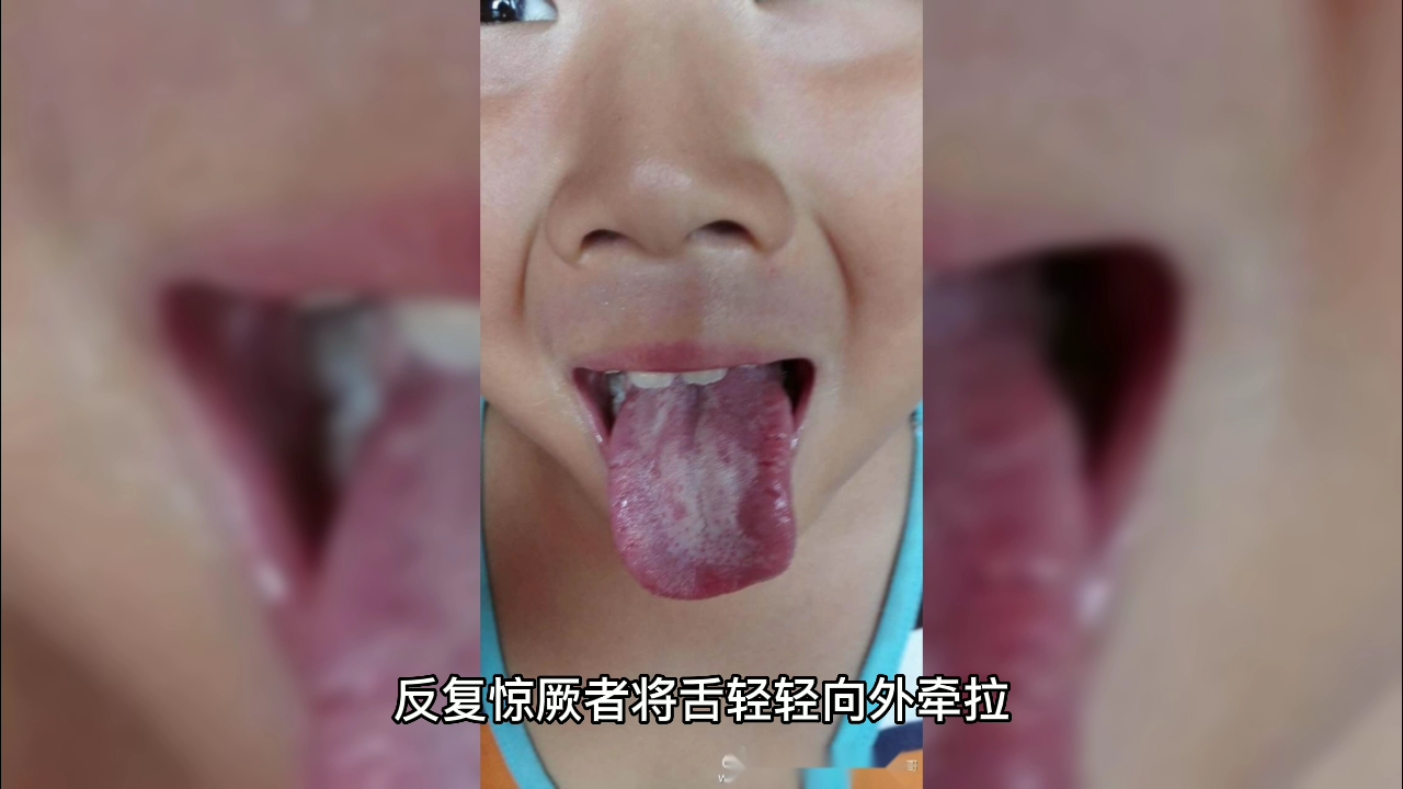 小儿惊厥的护理