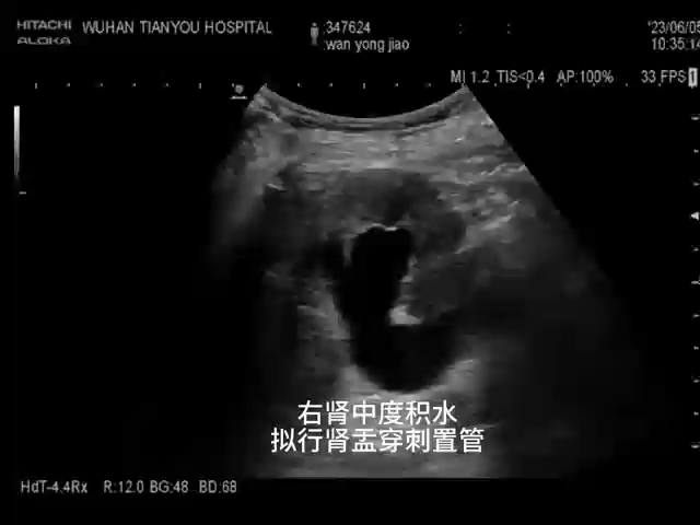 超声引导下两步法肾穿刺置管引流术