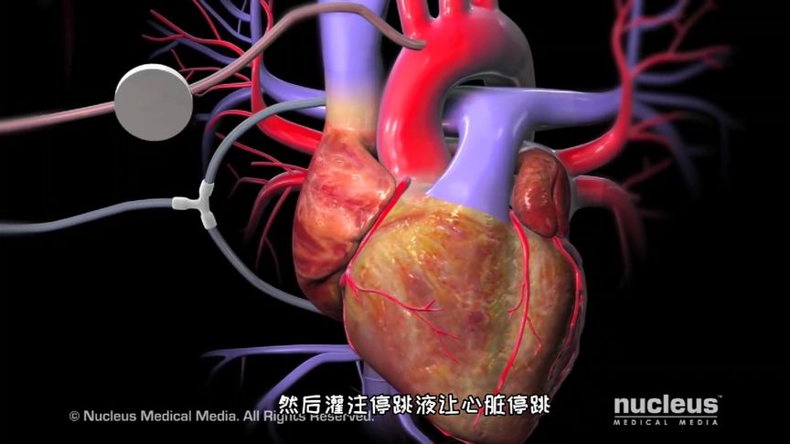 让心脏停跳,做心脏主动脉瓣置换术手术过程,3D演示。