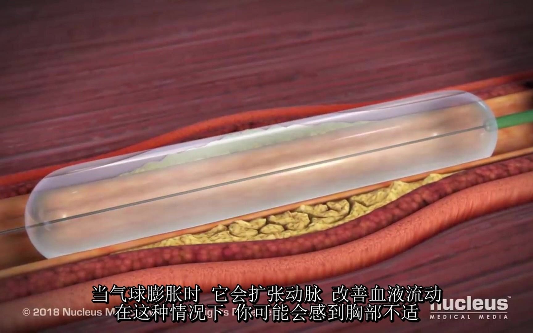 冠状动脉血管成形术(心脏支架介入手术)最直观视频讲解