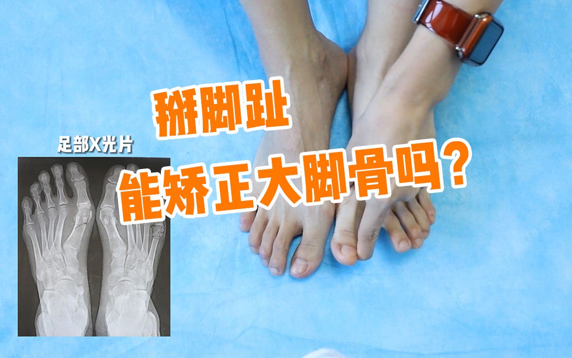 大脚骨医生苏敬达|听说扳脚趾能矫正拇外翻?别傻了,真不能!