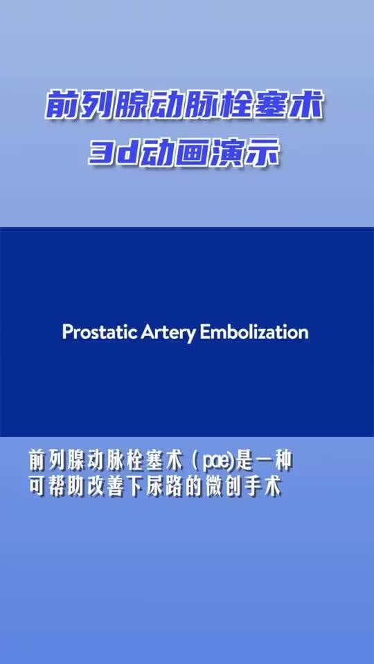 前列腺动脉栓塞术3D动画演示