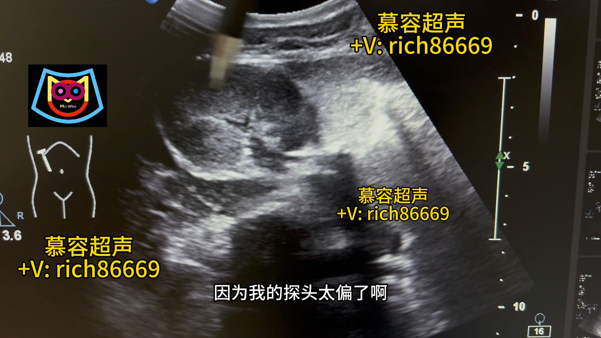 肾盂积水怎么测量呢?输尿管上段中段下段结石病例,想学习超声的,去...