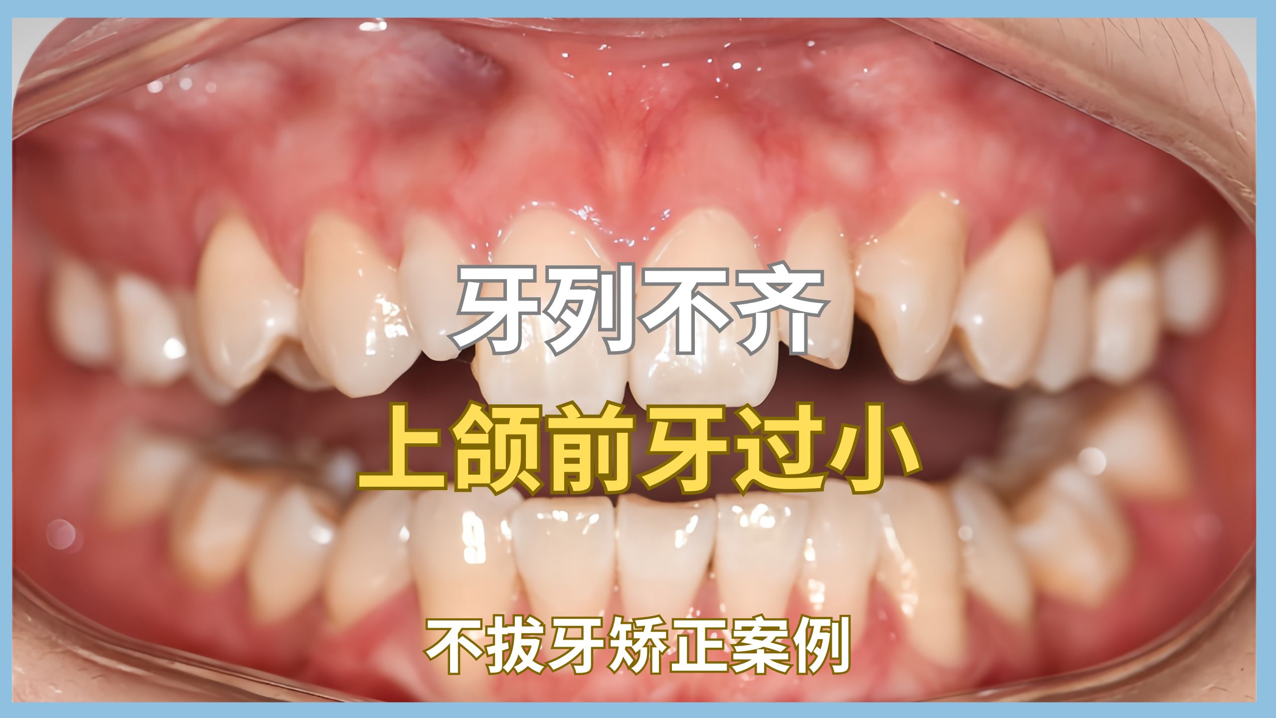 正畸进|牙齿不齐、形态不美观,如何矫正❓