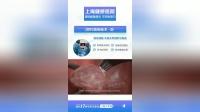 上海健桥医院:3D动画演示低温等离子消融扁桃体