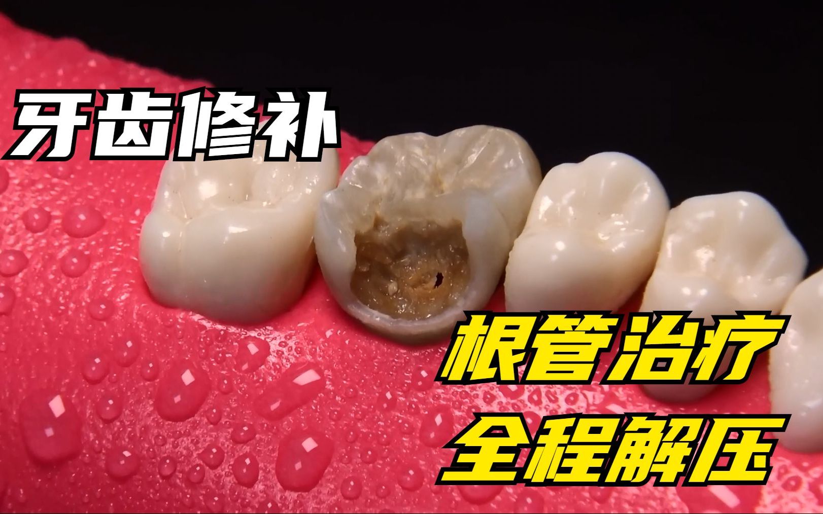 一颗坏牙怎么修复完好,根管治疗,全程解压。