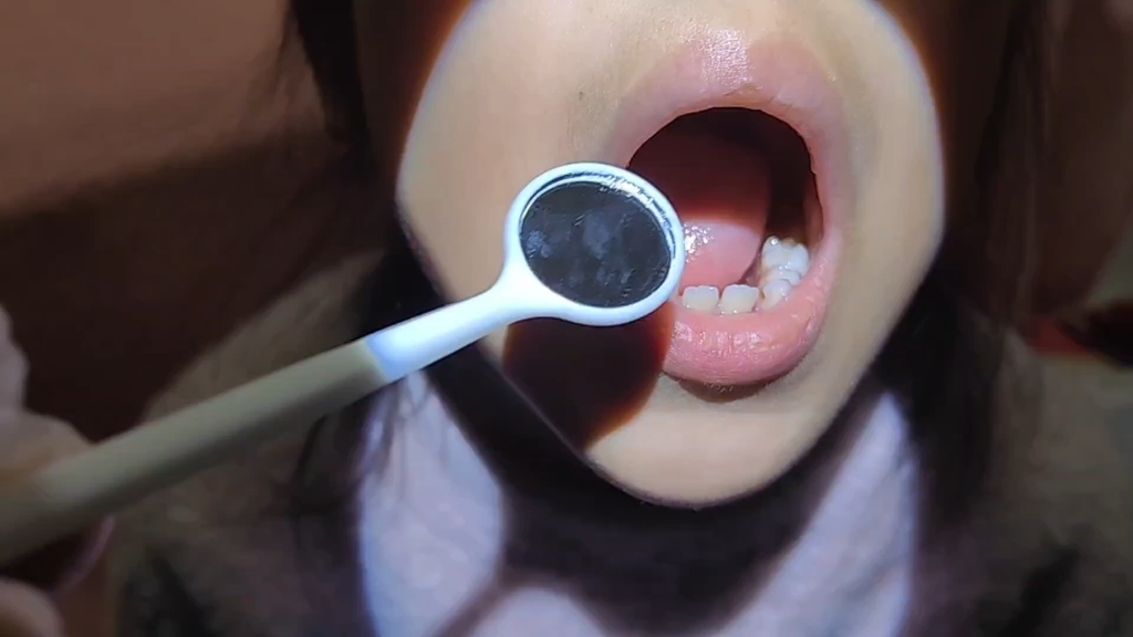 牙医爸爸在家给女儿治牙,第一次根管治疗,非专业人士请勿模仿