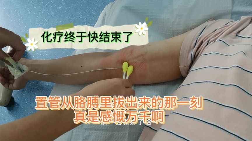 化疗结束拔管的那一刻感觉如释重负,picc管到底插进身体有多深?