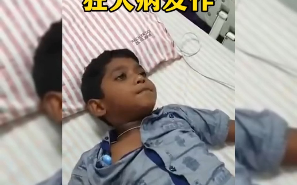 男孩被狗咬后居然像狗一样叫,被狗咬了之后实在是可怕#狂犬病