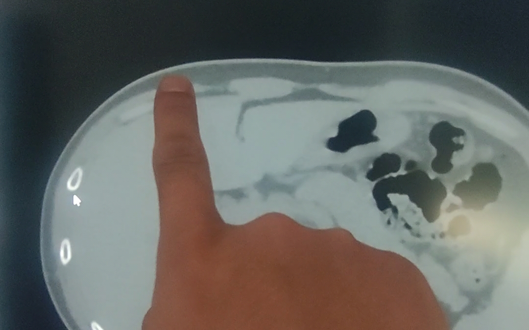 学习-胸部CT下数肋骨 快速学习应用