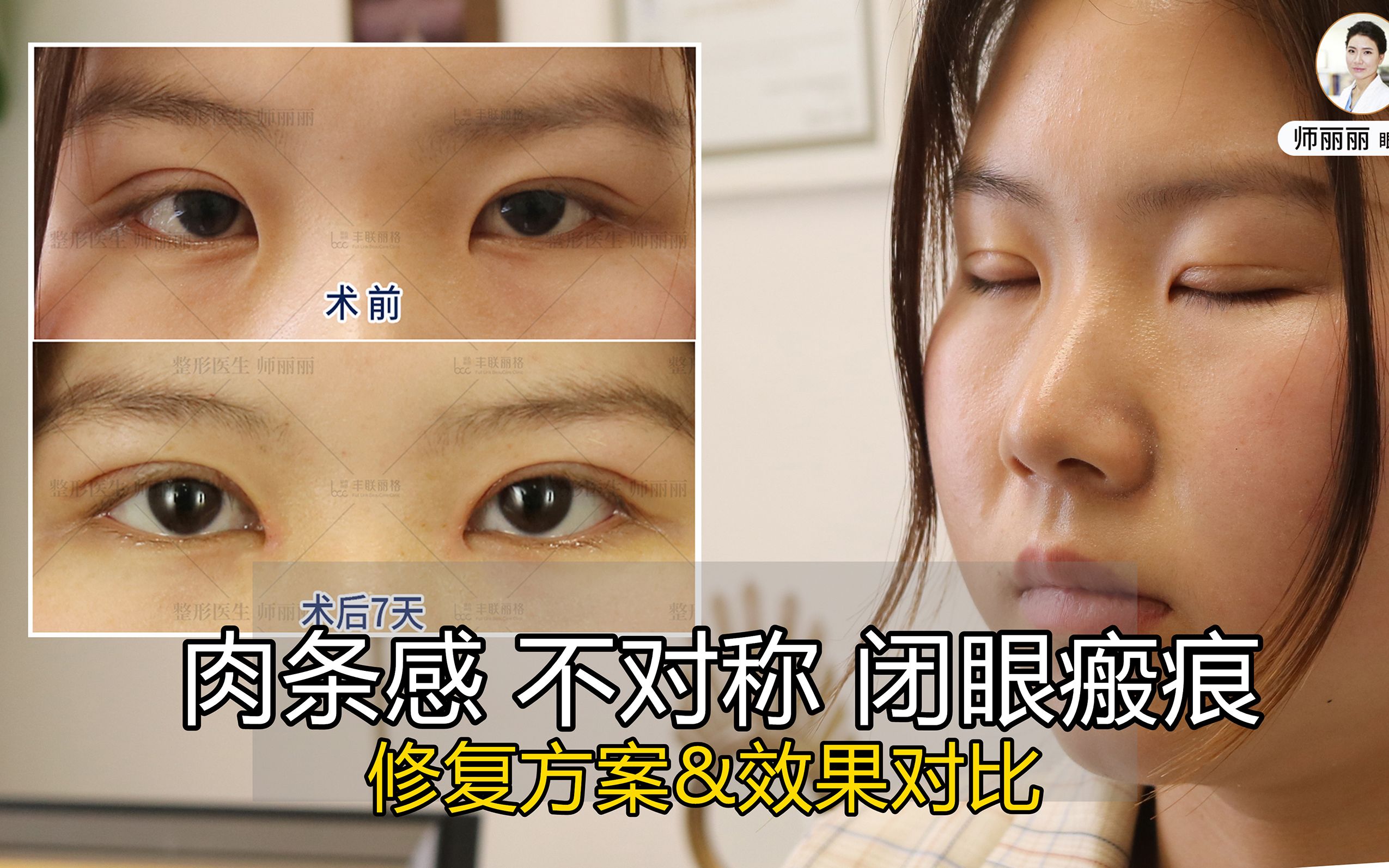 「修复」单侧肉条、双眼皮不对称、内眼角问题综合修复