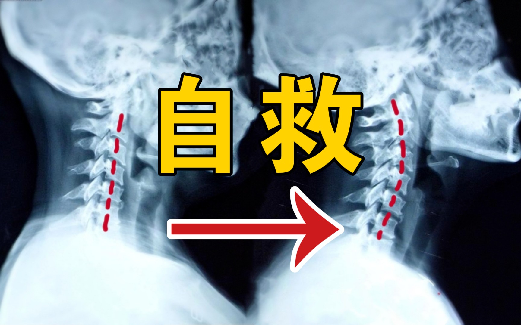 【颈椎自救】5个最舒服的康复动作,缓解肩颈疼痛僵硬!(坐姿版)
