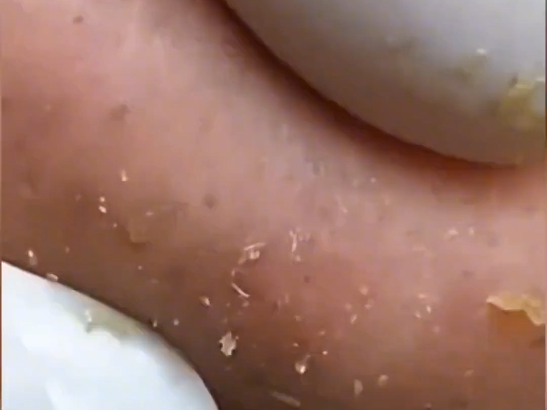 超级解压的挤黑头粉刺过程,内容易引起不适,请谨慎观看 #解压视频 #...