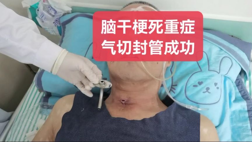 脑干梗死重症气切封管成功