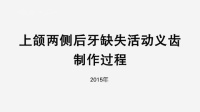 上颌两侧后牙缺失活动义齿制作过程 标清(270P)-57-136