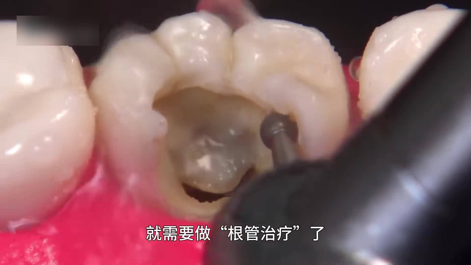 这就是根管治疗的全过程