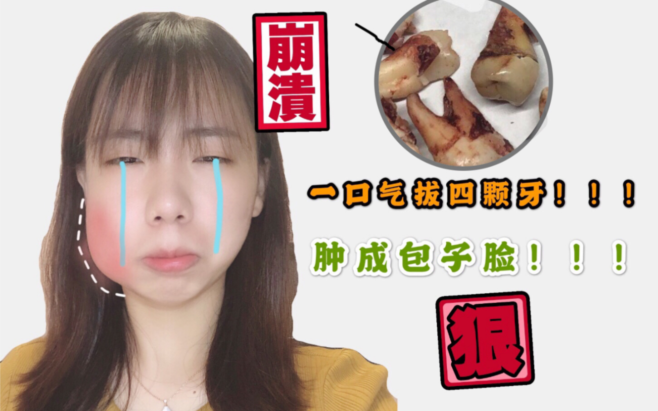 【小羊的正畸之路】不是吧 阿sir,一口气拔4颗牙,这么狠?!