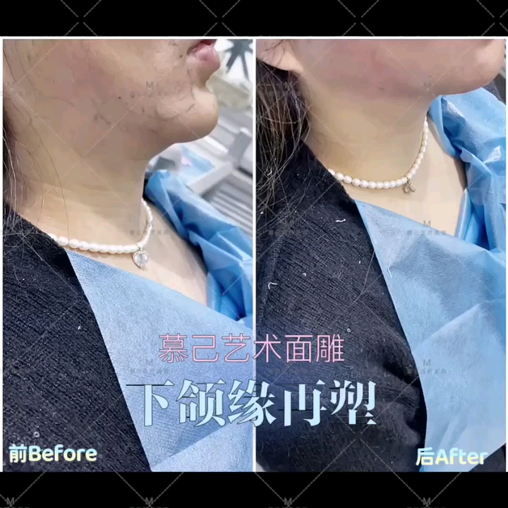 下颌缘再塑即刻效果。通过固定支撑对周围软组织起到长久抗衰的作用...