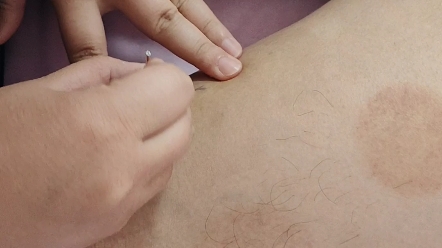 刃针松解竖脊肌与半腱肌损伤