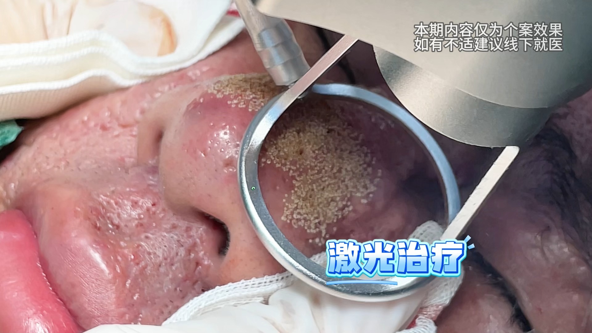 严重痤疮疤痕的激光治疗过程实拍