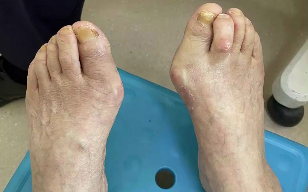 【苏敬达】60岁阿姨来面诊,重度拇外翻脚底都是茧子