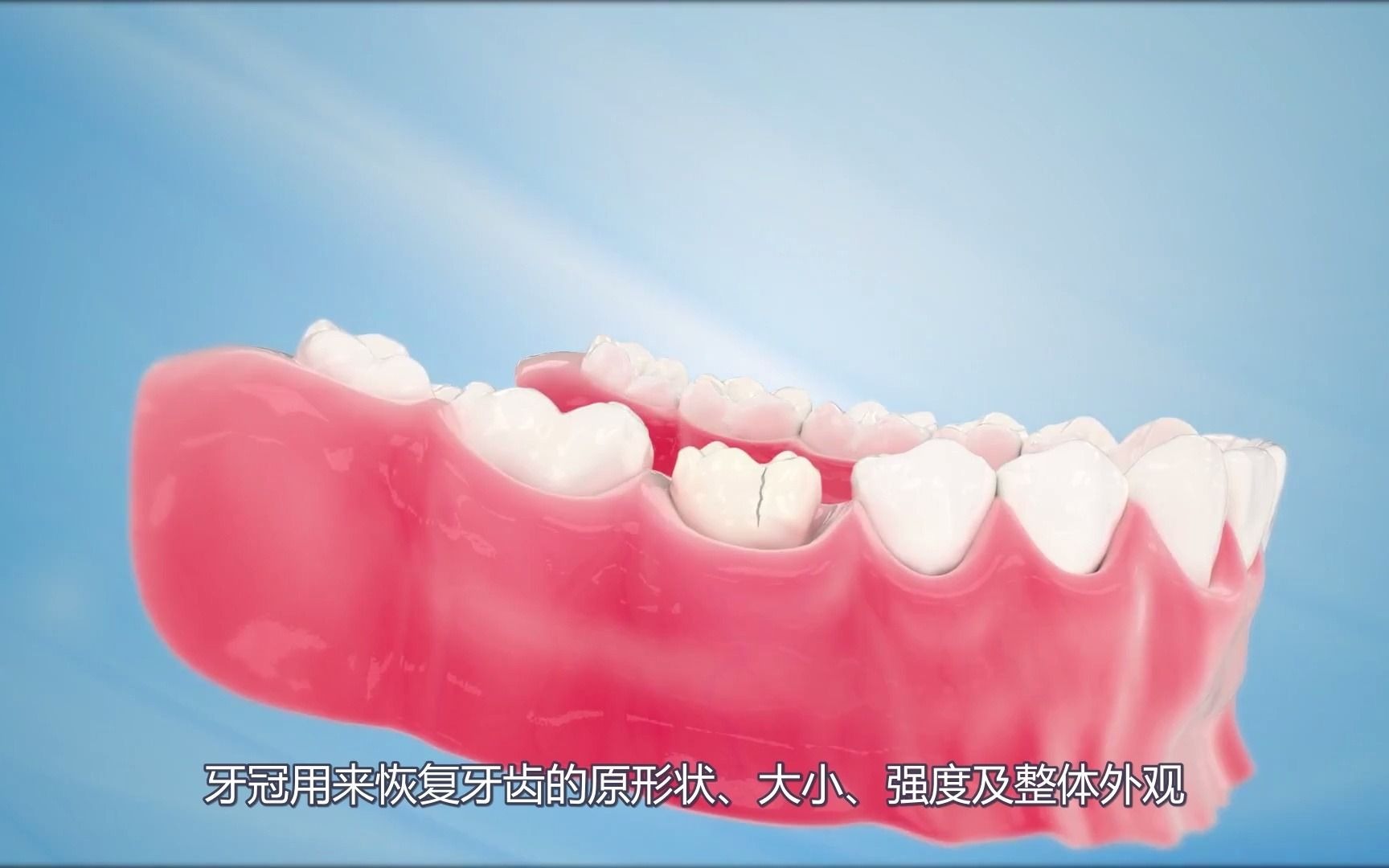 【字幕】根管治疗要戴冠?牙隐裂戴冠?来看看牙冠到底是什么呢