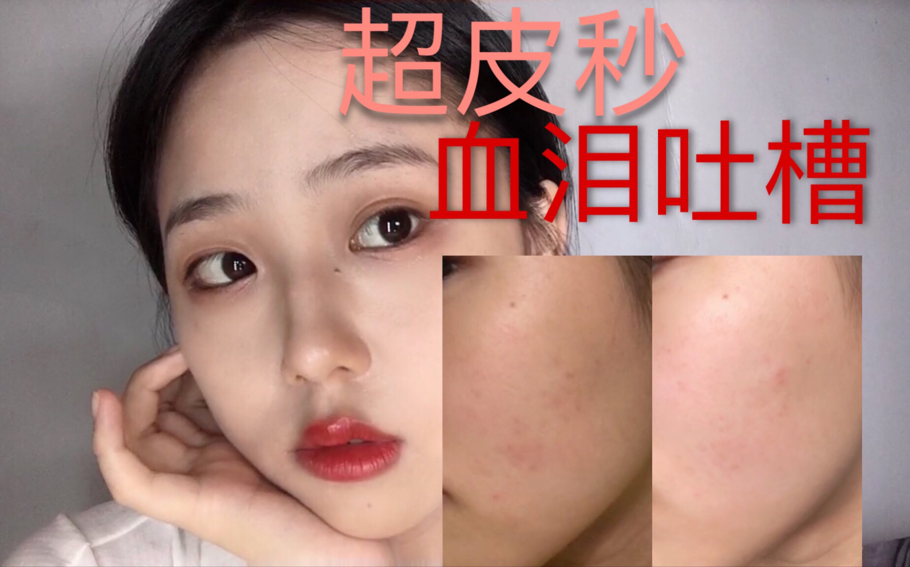 ...的超皮秒经历|三大超皮秒模式你都知道吗|术后注意事项|手术效果对比