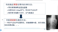 鼻肠管盲插置管流程及技巧