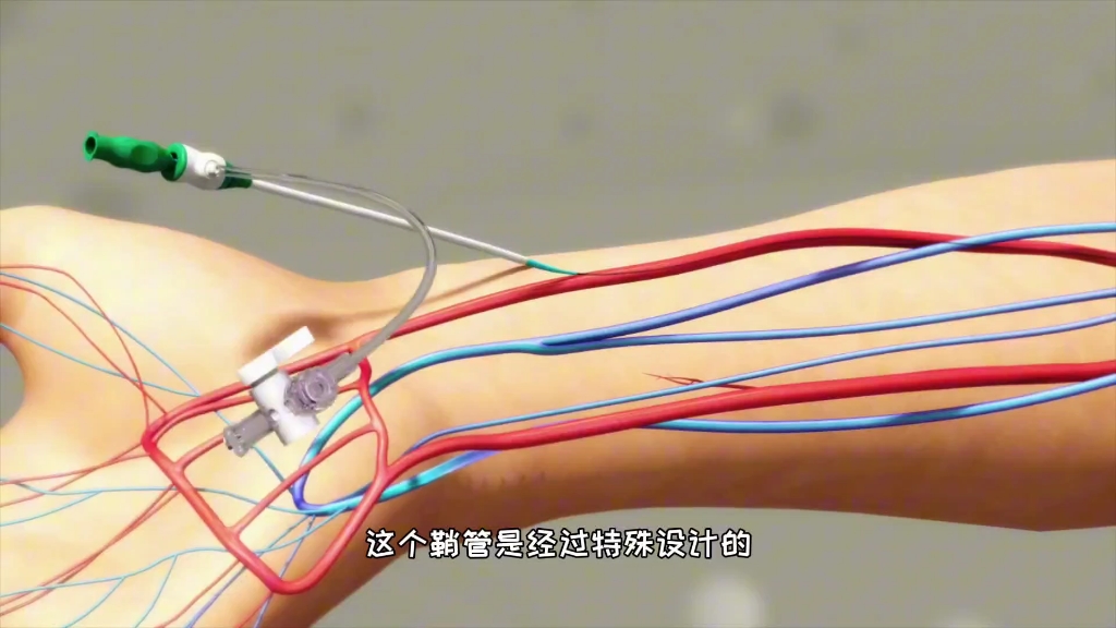冠状动脉造影时,桡动脉穿刺怎么做,3D演示。