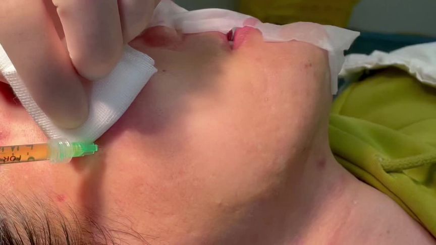 痘坑的PRP(富血小板血浆)的注射治疗#痘坑 #医学科普仅供参考