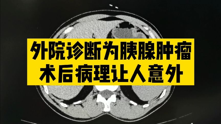 外院CT提示胰腺肿瘤,术后诊断为小肠间质瘤,定位很重要!