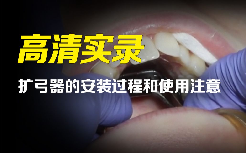 高清实录!不想拔牙?了解扩弓器安装和注意事项!
