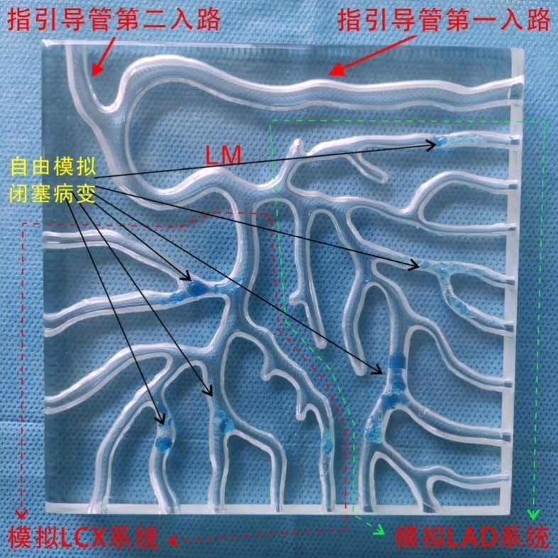冠脉造影 冠脉介入模拟器 冠脉支架 植入 心脏支架