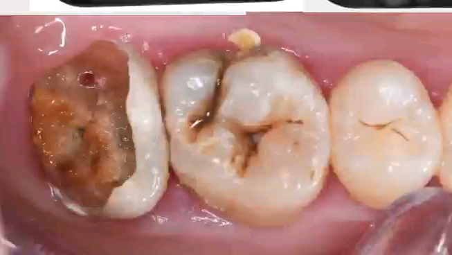 爱吃甜食的美女 右上最后一颗牙齿基本坏完了,根管治疗后修复起来