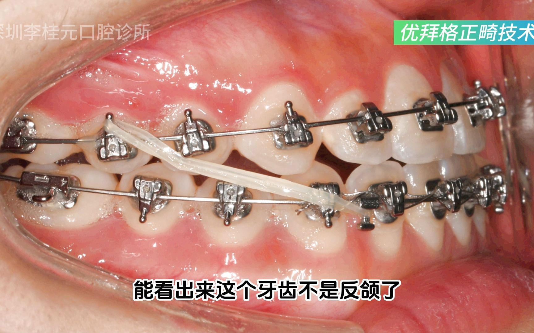 地包天佩戴优拜格托槽六个月(优拜格正畸技术)