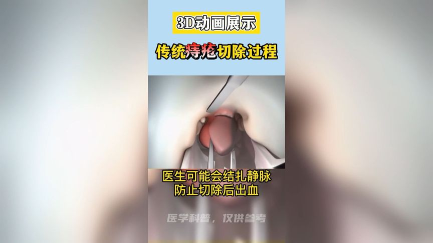 3D动画验证,传统痔疮切除过程